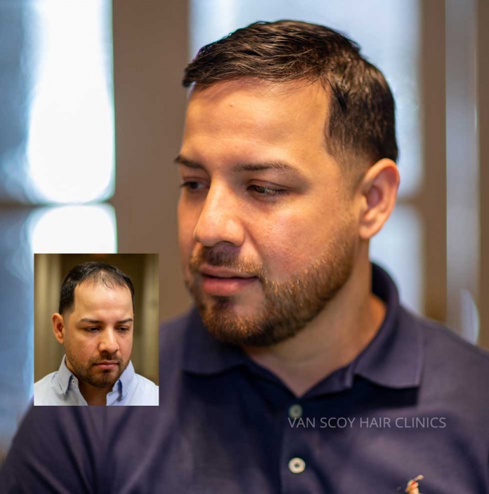 Ohio Hair Restoration & Hair Transplant Experts | Hair Replacement ...