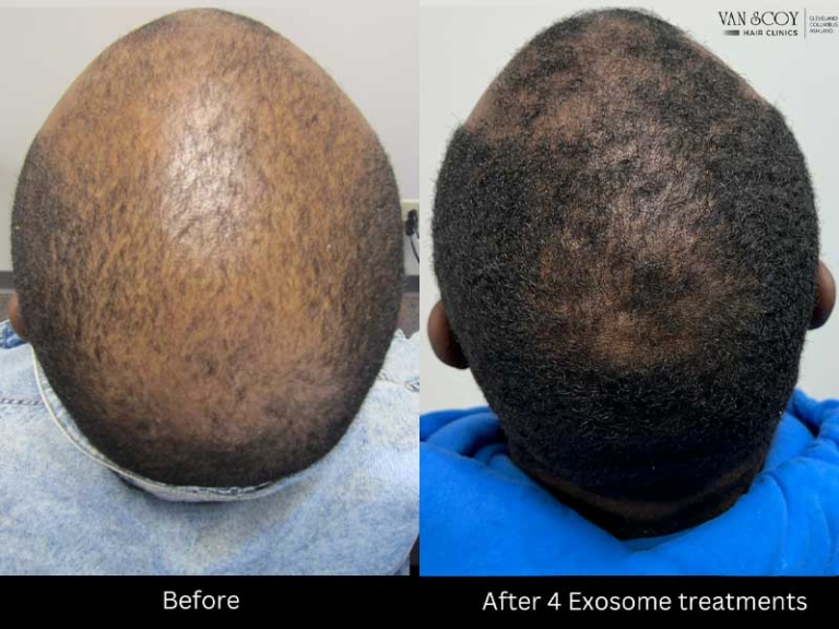 Exosome Treatment for Hair Loss | Van Scoy Hair Clinics