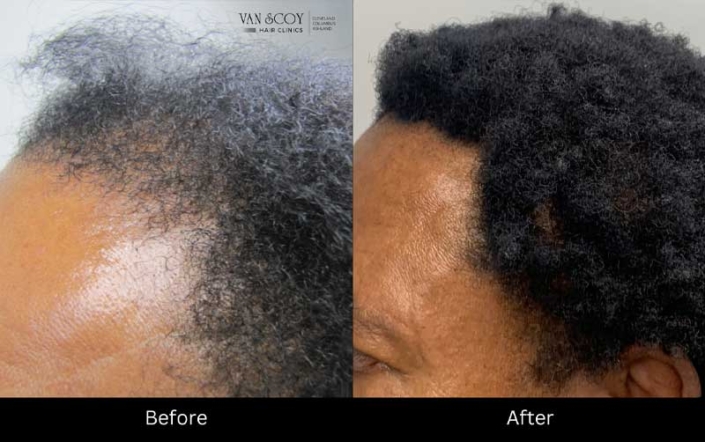 Hair Transplants Ohio | Hair Restoration | Cleveland Columbus Ashland